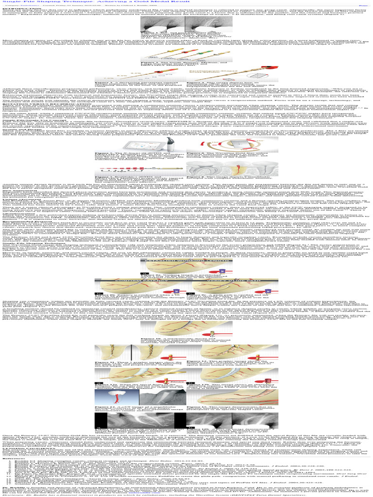 Single-File Shaping Technique | PDF