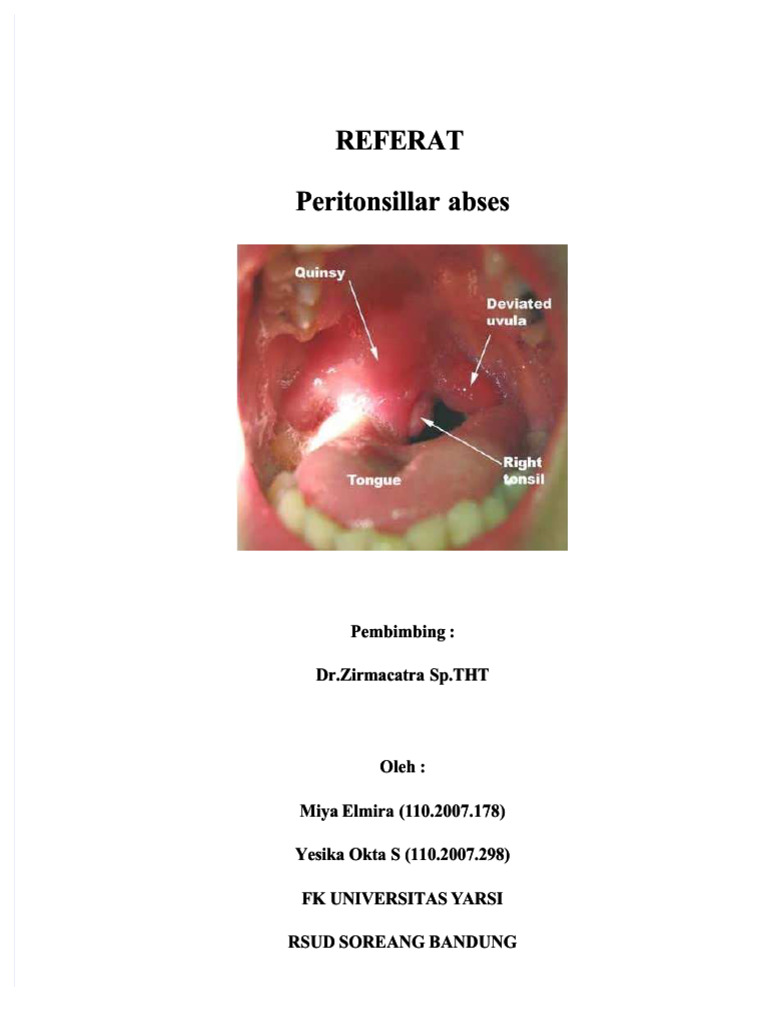 Abses Peritonsil: Gejala dan Penyebab | PDF