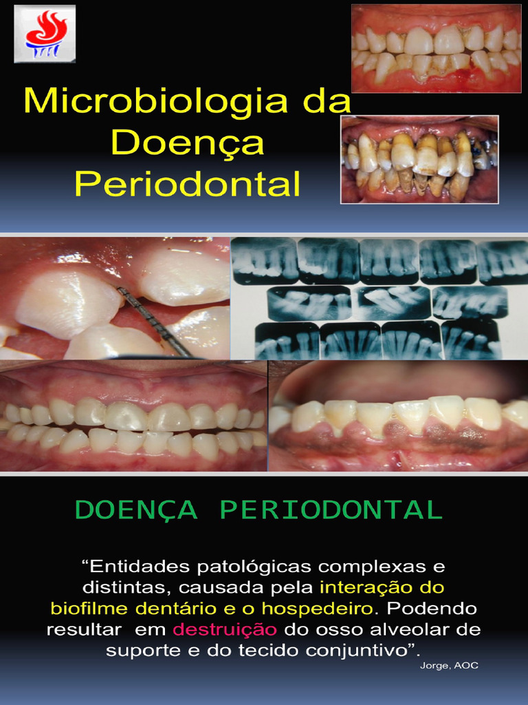 Doenças Periodontal | PDF