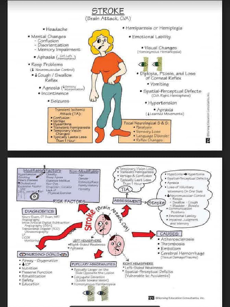 Stroke Brain Attack CVA Neurologic Disease | PDF
