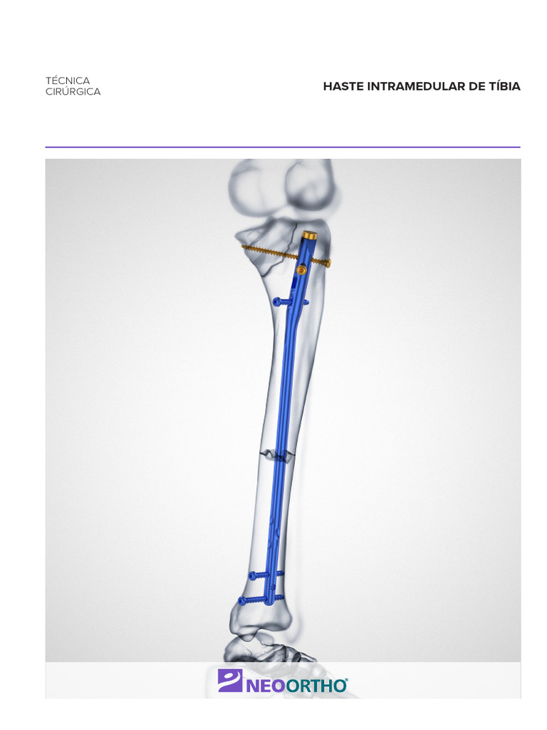 501.500-01 Haste Intramedular Tibia | PDF | Joelho