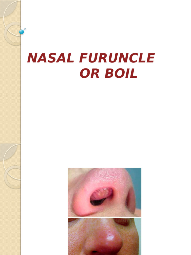 Nasal Furuncle or Boil | PDF