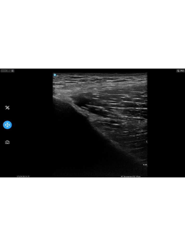 Ecografia TFL 1 | PDF