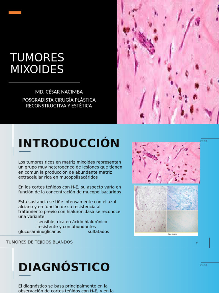 Tumores Mixoides: Diagnóstico y Clasificación | PDF | Sarcoma | Neoplasias