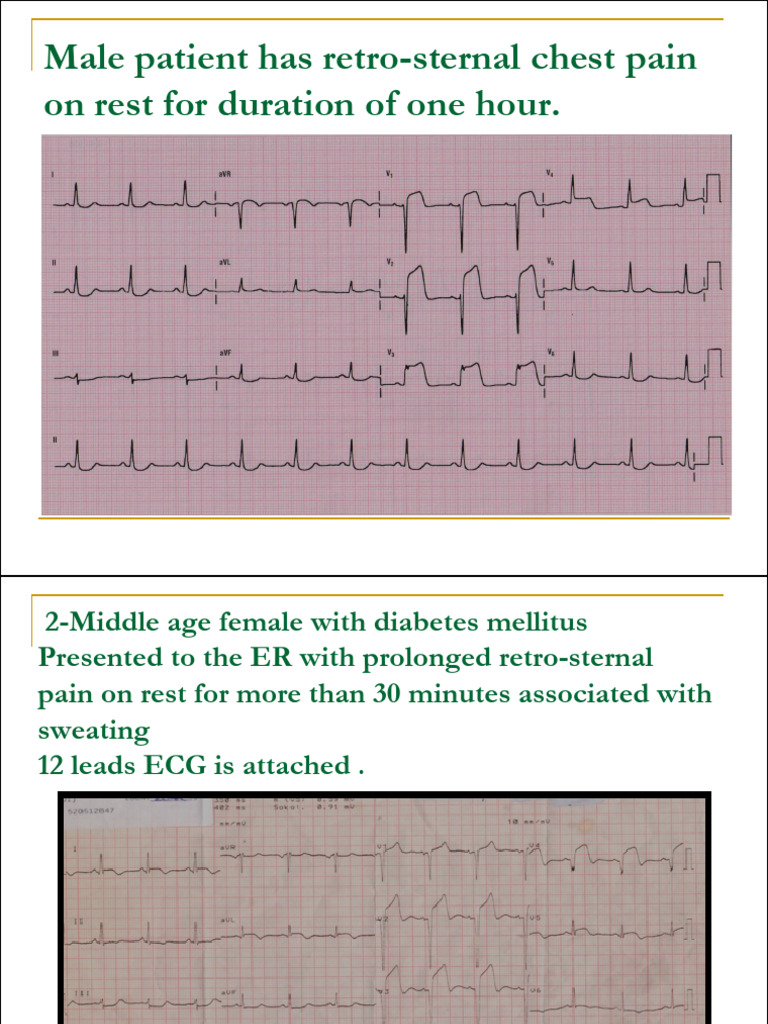 Abnormal ECG 2024 | PDF | Electrocardiography | Myocardial Infarction