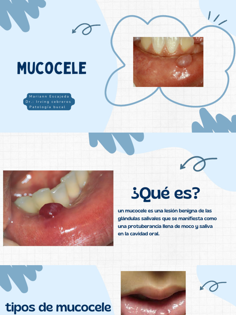 Mucocele 2 | PDF | Estudios de idiomas extranjeros | Salud y bienestar