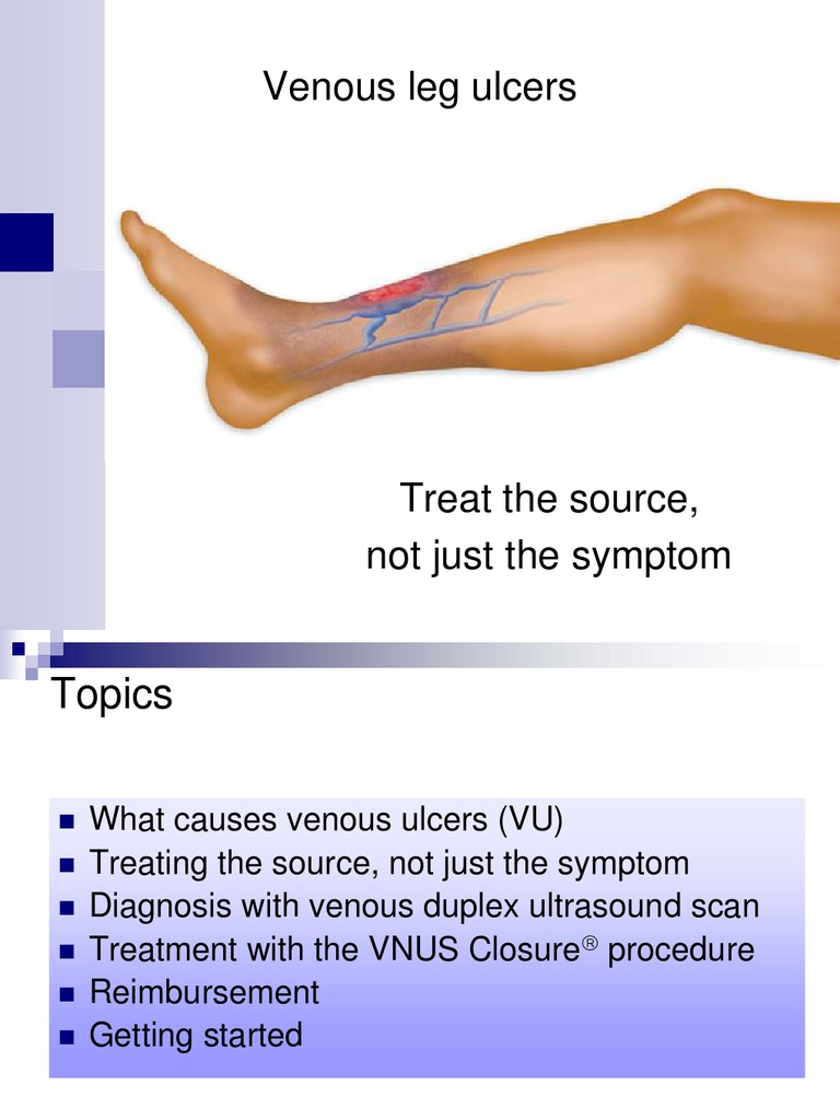 Venous Ulcers | PDF | Vein | Thrombosis