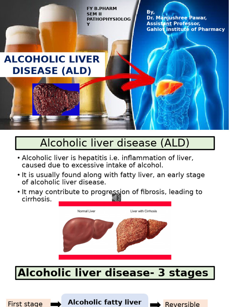 Alcoholic Liver Disease (Ald) : By, Dr. Manjushree Pawar, Assistant Professor, Gahlot Institute ...