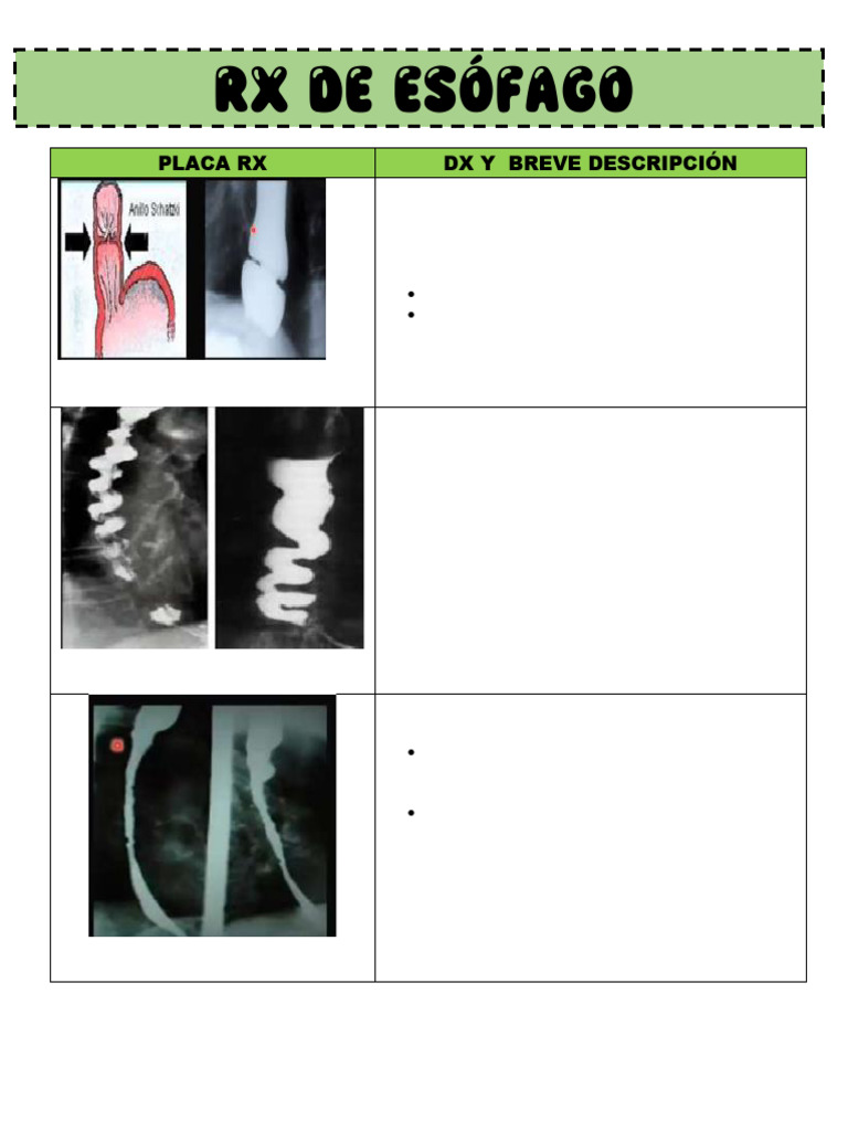 Rx de Esófago | PDF | La enfermedad por reflujo gastroesofágico | Esófago
