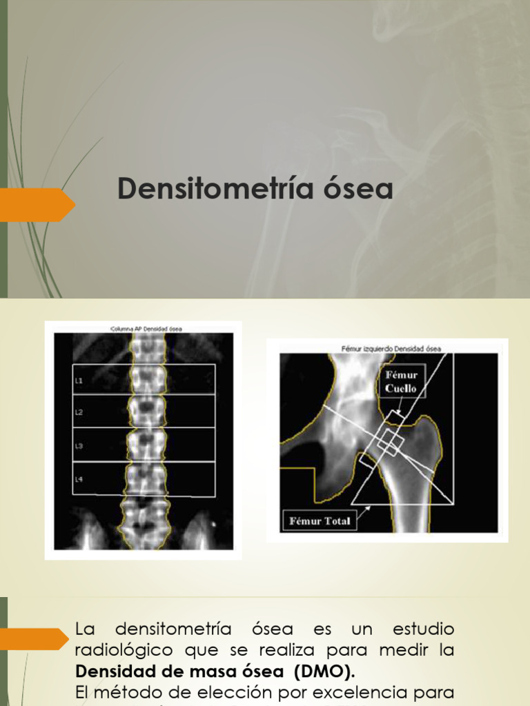 Densitometría Ósea | PDF | Osteoporosis | Especialidades Medicas