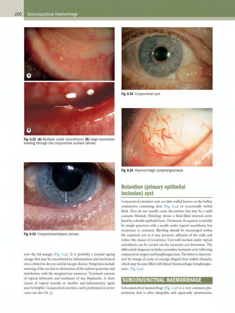 Kanski Páginas | PDF | Cornea | Contact Lens