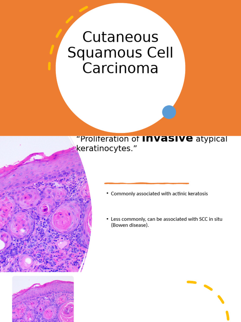 Cutaneous Squamous Cell Carcinoma | PDF | Epithelium | Medical Specialties