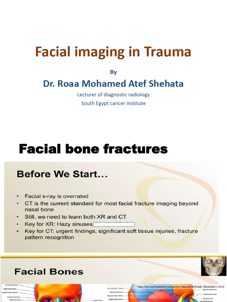 Facial Fractures | PDF