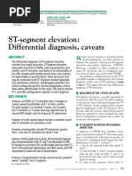 Ecg Interpretation J Point Stemi Criteria Equivalents and Others | PDF ...