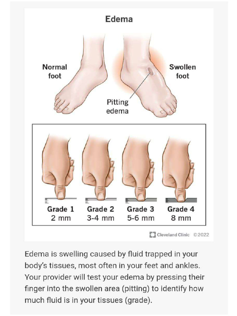 Edema | PDF