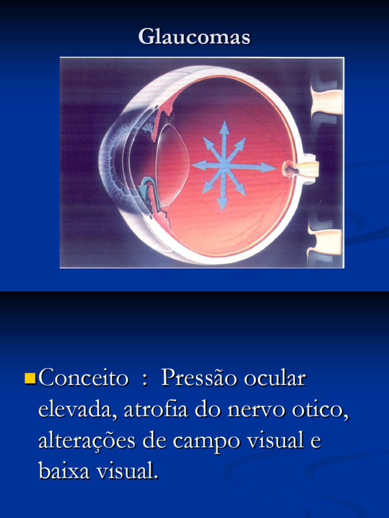 Aula 8 - Glaucoma | PDF | Glaucoma | Oftalmologia