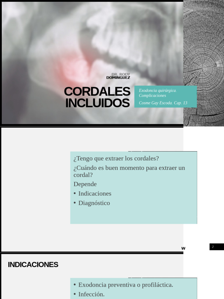 Exodoncia de Cordales Incluidos | PDF | Cirugía | Hueso