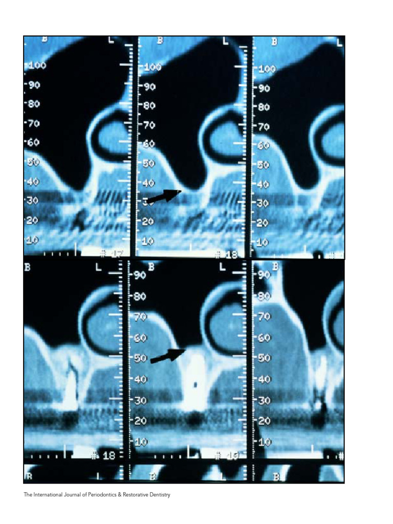 The Modified Osteotome Technique | PDF | Dental Implant | Medical ...