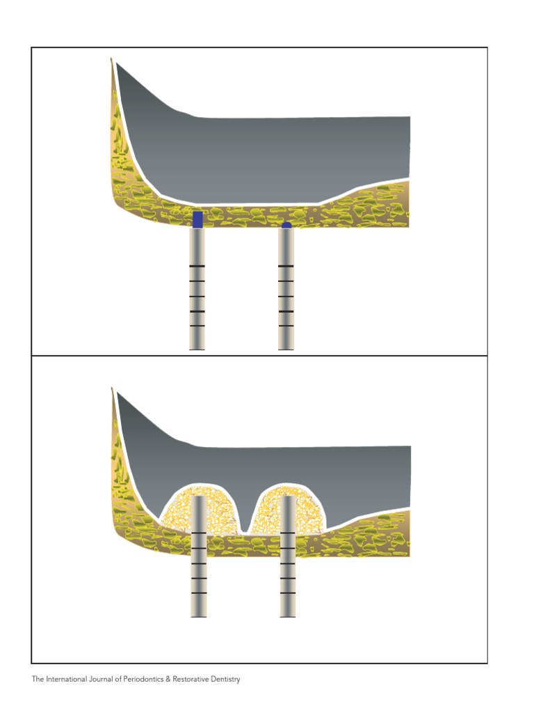 Staged Osteotome Technique | PDF | Human Head And Neck | Surgery