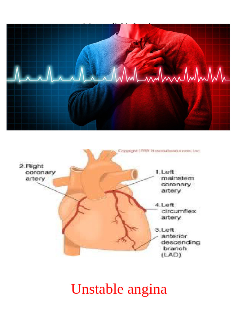 Myocardial Infarction, Stable Angina-1 - 100744 | PDF | Science ...
