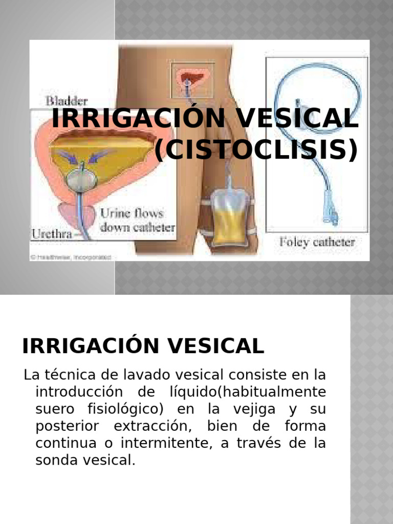 Guía de Irrigación Vesical y Sondaje | PDF | Urología | Sistema ...