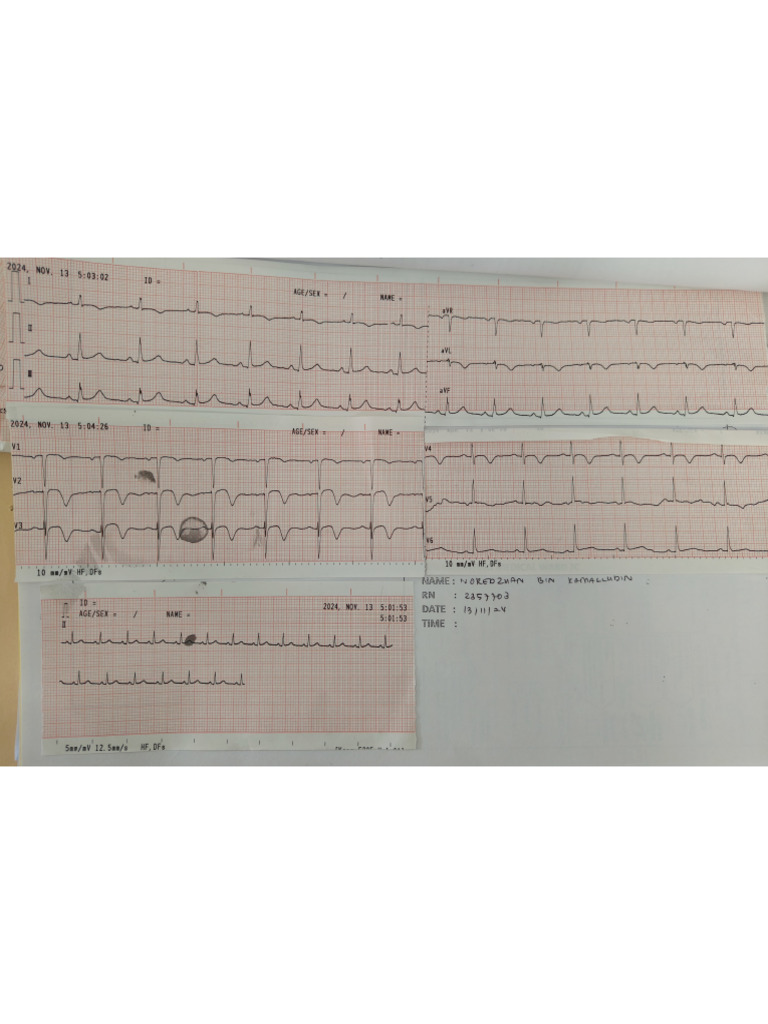 ECG | PDF