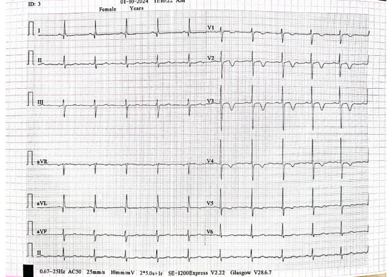 Ecg 3 | PDF