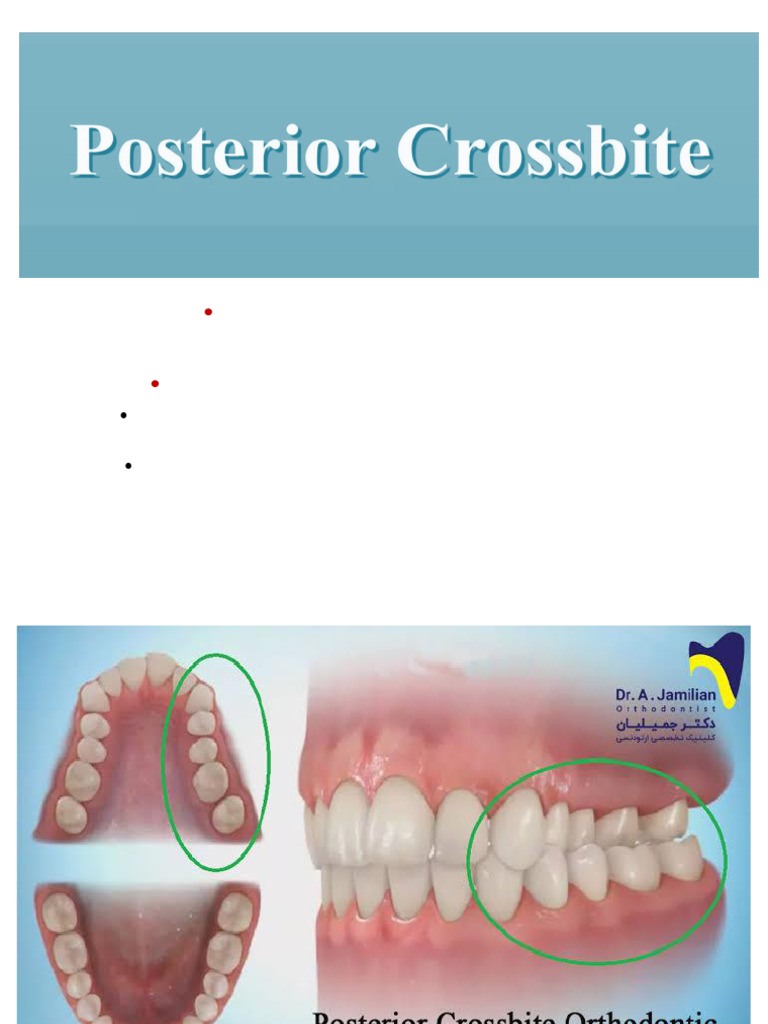 Crossbite Diagnosis and Correction Techniques | PDF