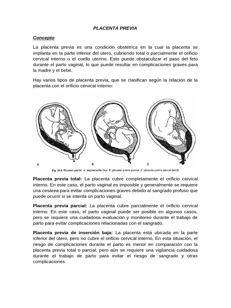 Placenta Previa | PDF | Parto | El embarazo