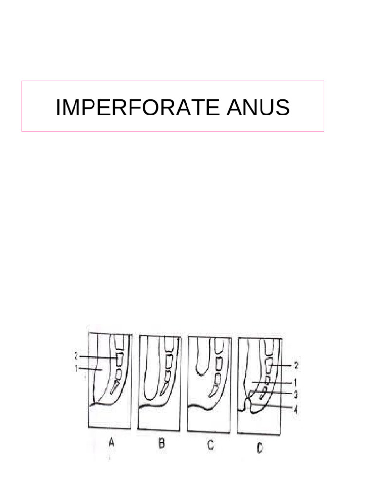 Imperforate Anus | PDF