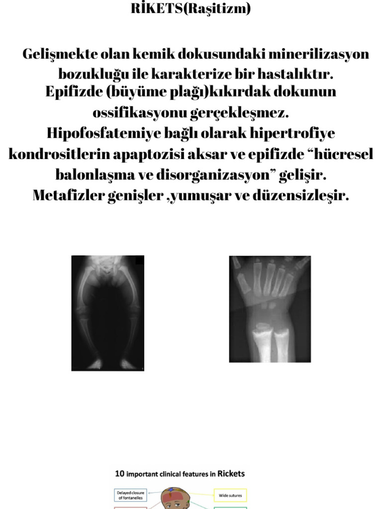RİKETS (Raşitizm) | PDF