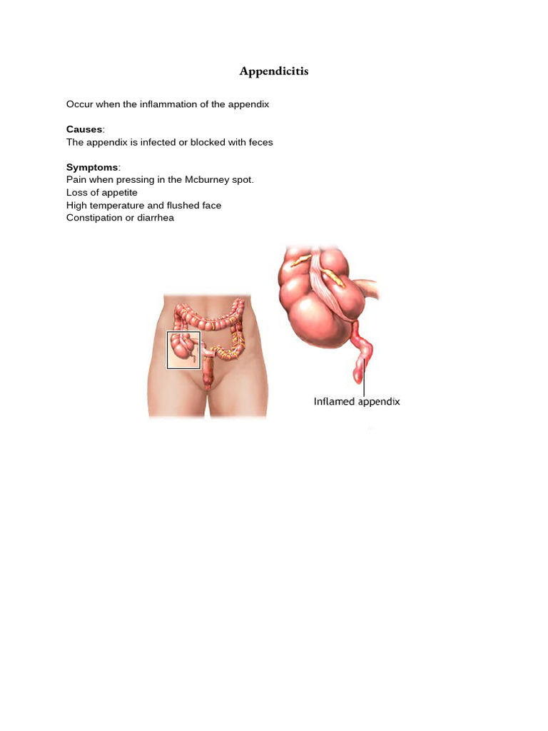 Appendicitis | PDF