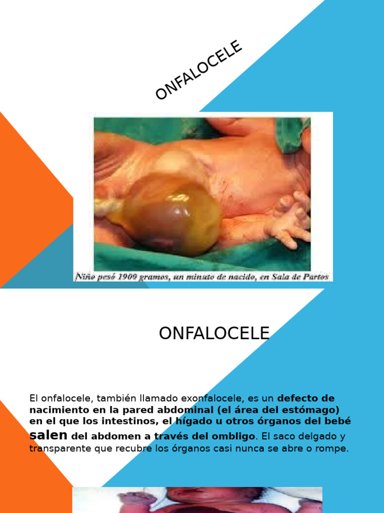 ONFALOCELE | PDF | Abdomen | El embarazo