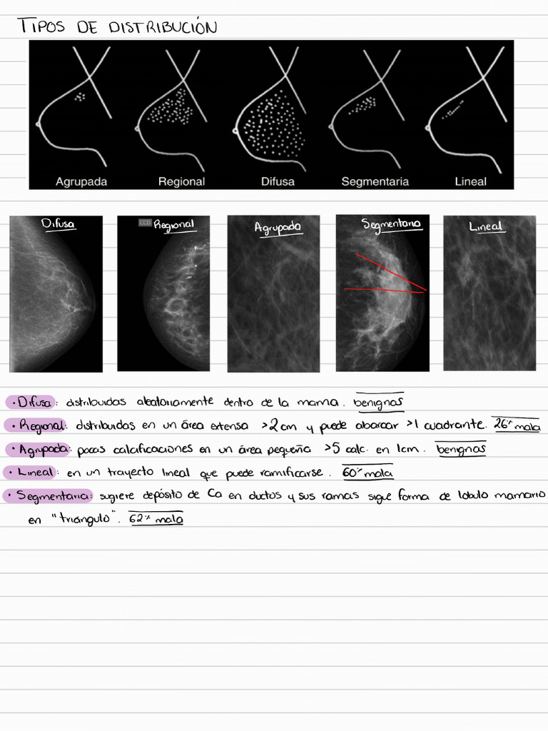 Calcificaciones Mamarias | PDF