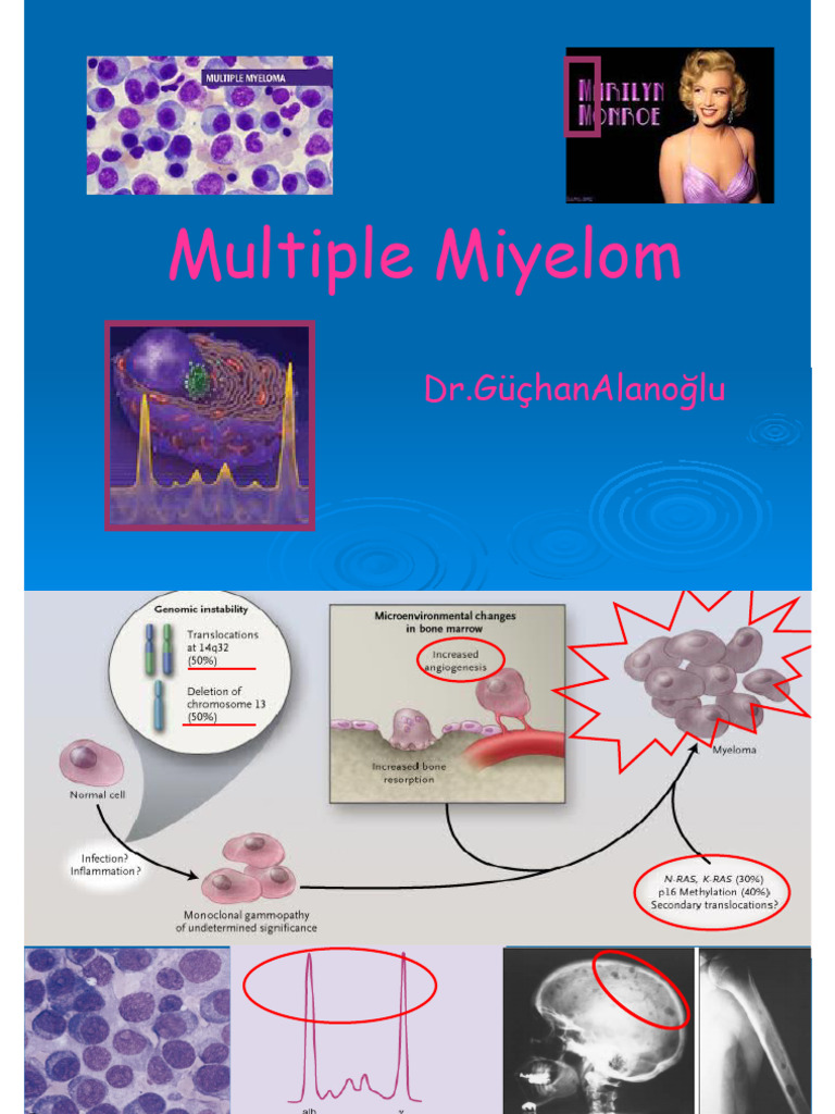 Multiple Myelom | PDF