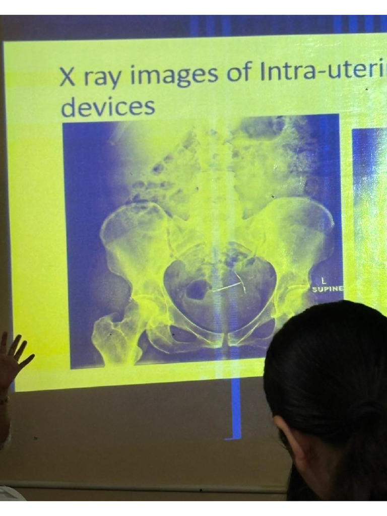 Obs Xray and HSG | PDF