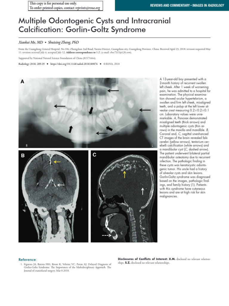 Multiple Odontogenic Cysts and Intracranial | PDF | Neoplasms | Causes ...