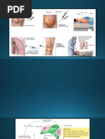 Criterios de Light para Derrames Pleural | PDF