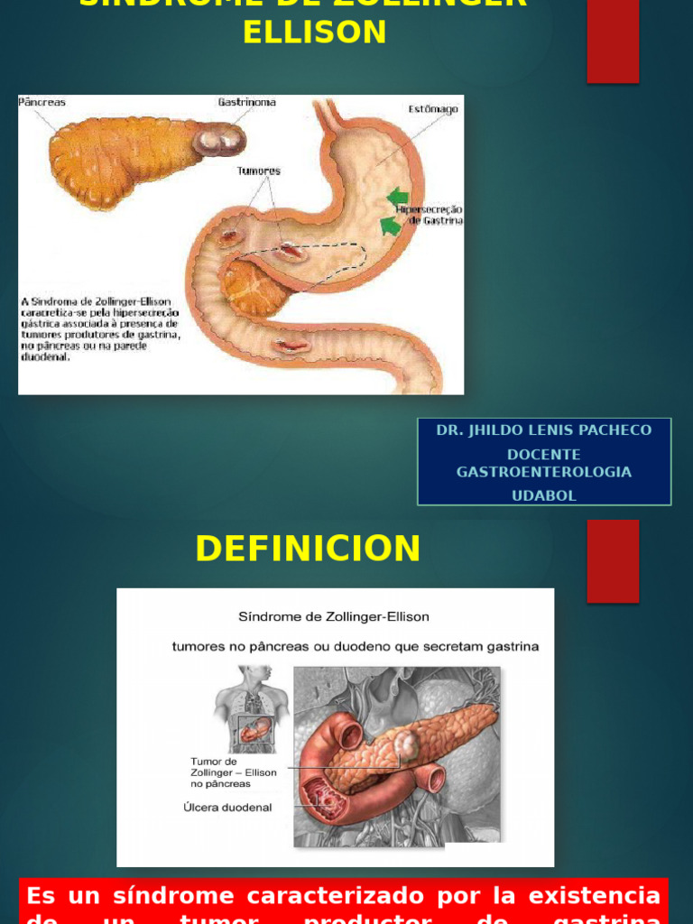 Sindrome de Zollinger - Ellison - PPT 2020 | PDF | Medicina CLINICA ...