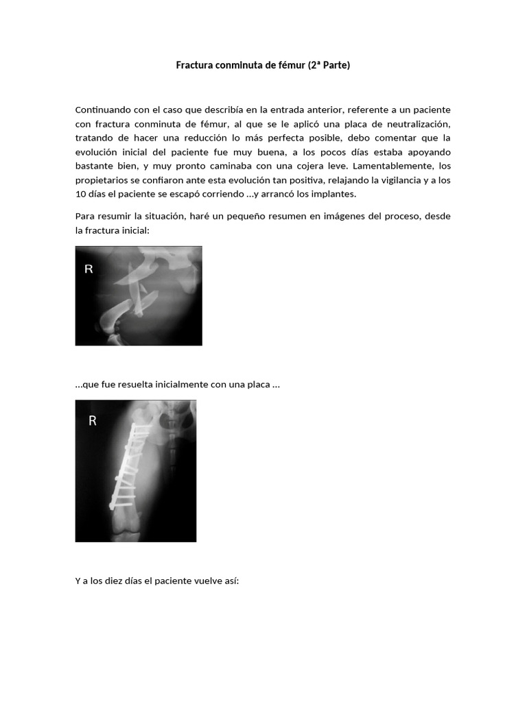 11 - Fractura Conminuta de Fémur. 2 Parte | PDF | Hueso | Medicina CLINICA