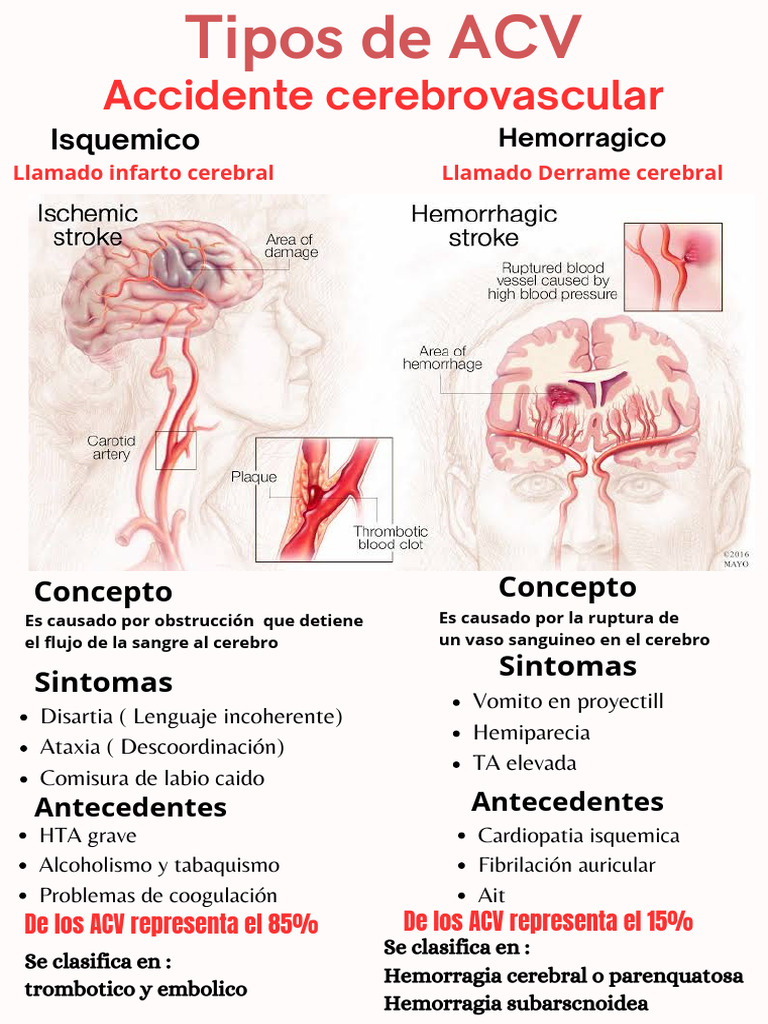 Tipos de Accidente Cerebrovascular (ACV) | PDF