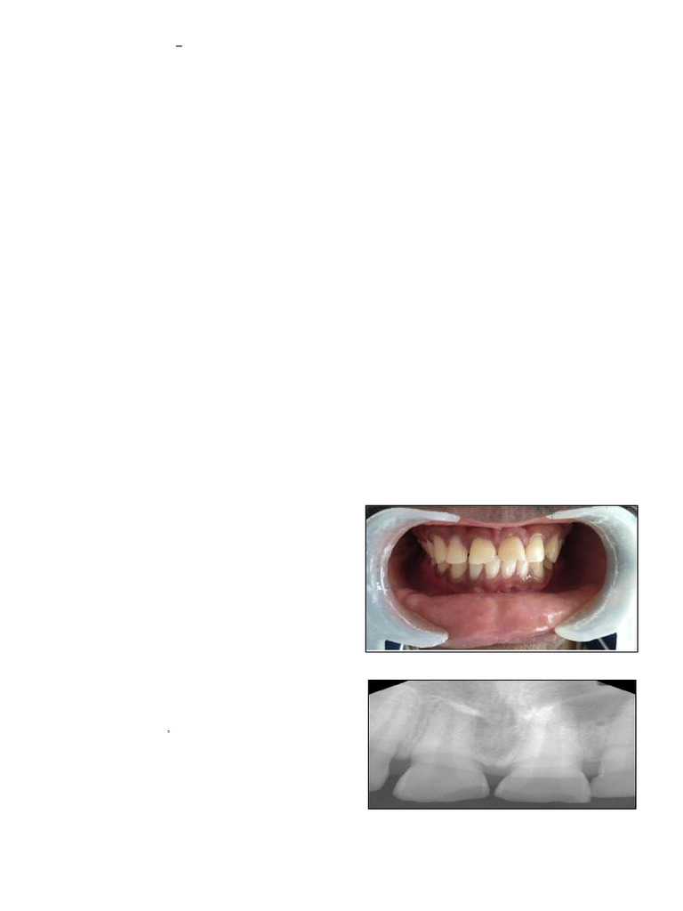 Management of Maxillary Anterior Tooth With Open Apex by MTA ...