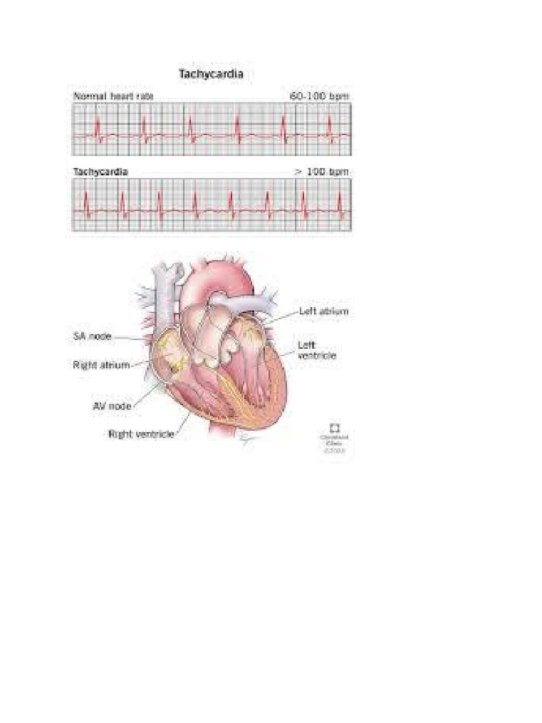 Tachycardia | PDF