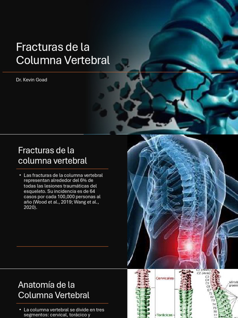 Fracturas de Columna Vertebral: Diagnóstico y Tratamiento | PDF | La ...