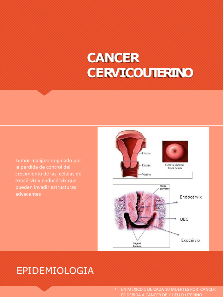 Cáncer Cervicouterino: Epidemiología y Tratamiento | PDF | Cáncer ...