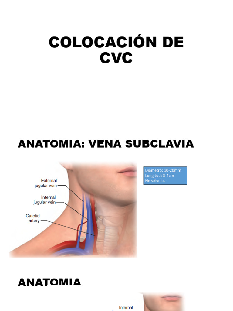 Colocación de CVC | PDF