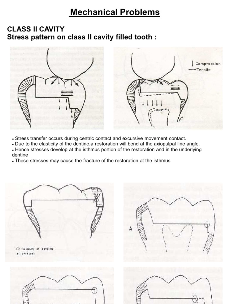 Class II Cavity | PDF | Social Science | Art