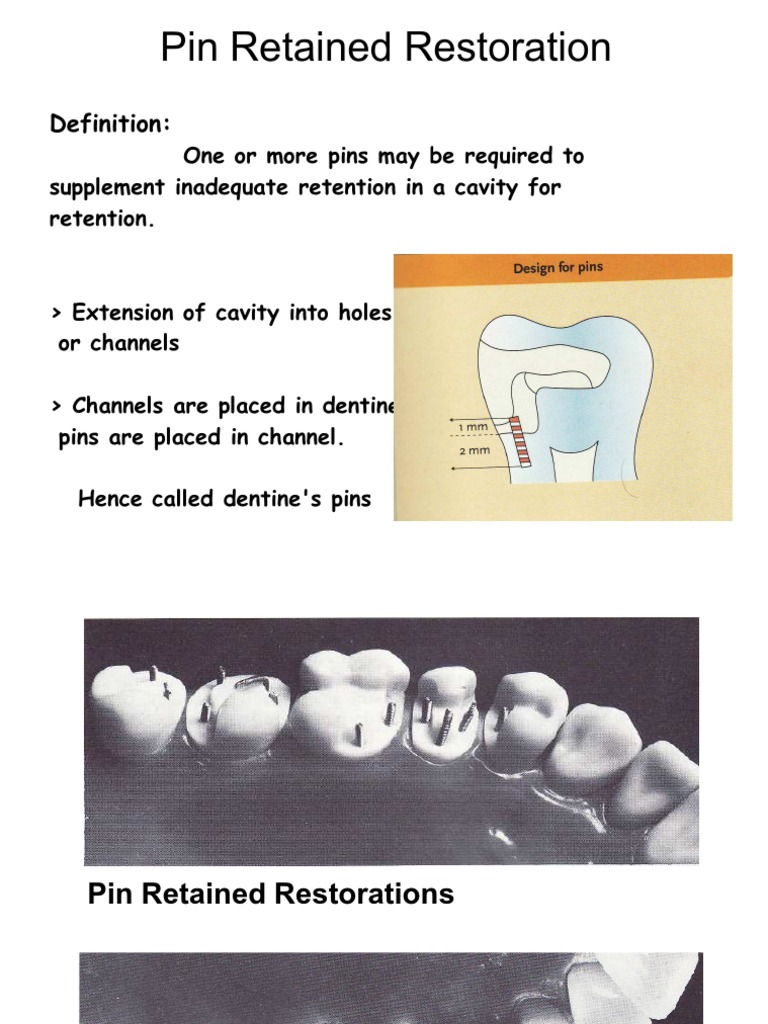 Pin Retained Restoration | PDF | Dentin | Tooth