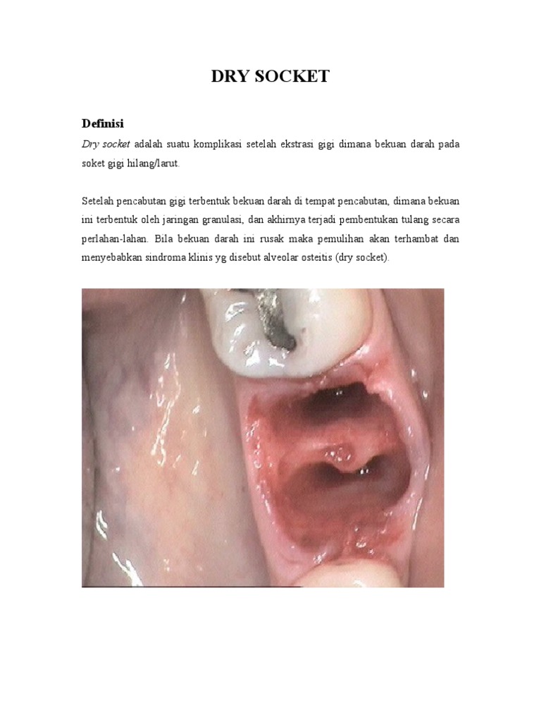 Dry Socket | PDF
