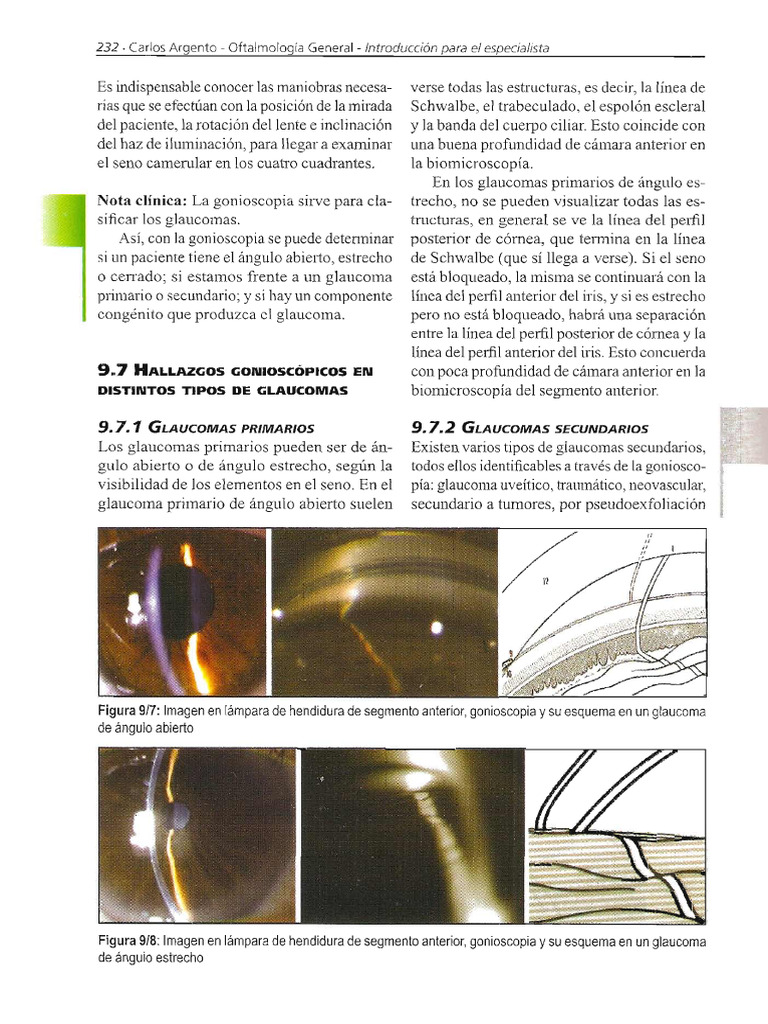 Glaucoma 2 | PDF | Glaucoma | Enfermedades y trastornos